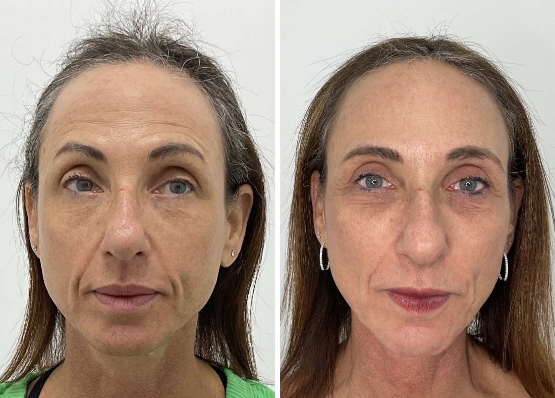 Sciton Contour TRL - NanoLaserPeel, MicroLaserPeel - Aesthetic Laser ...