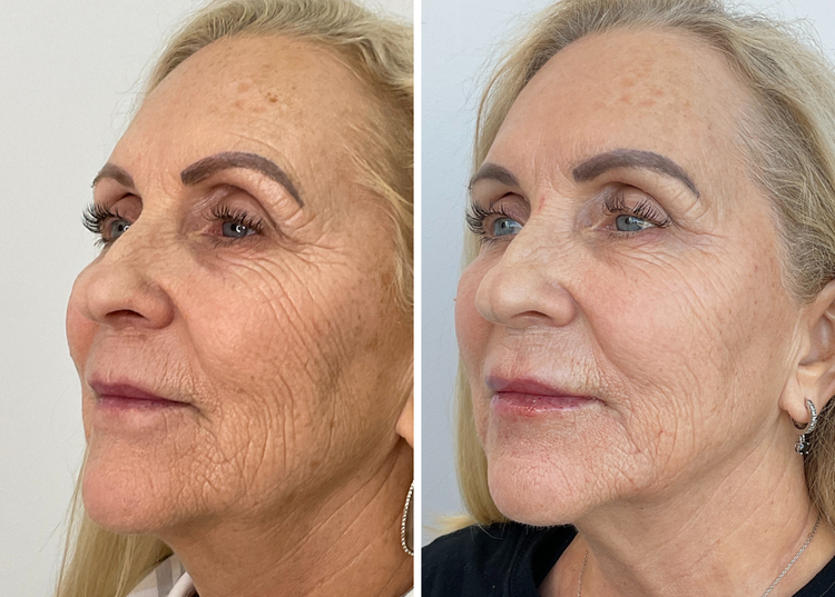 Sciton Contour TRL - NanoLaserPeel, MicroLaserPeel - Aesthetic Laser ...