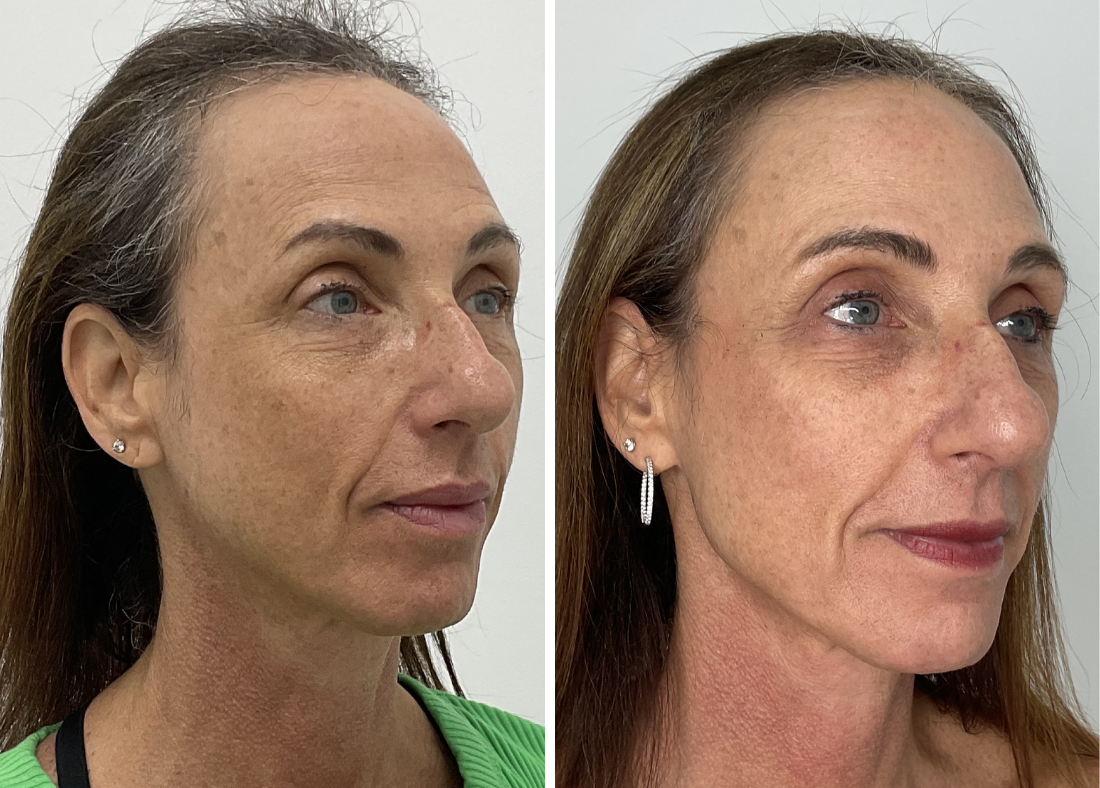 Sciton Contour TRL - NanoLaserPeel, MicroLaserPeel - Aesthetic Laser ...