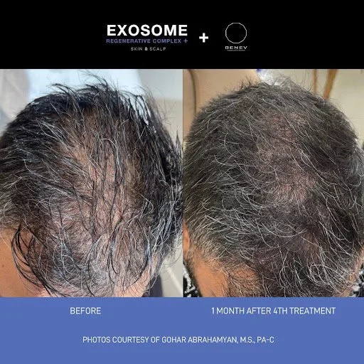 Benev Exosomes - Enhance Your Treatment With Topical Growth Factors ...