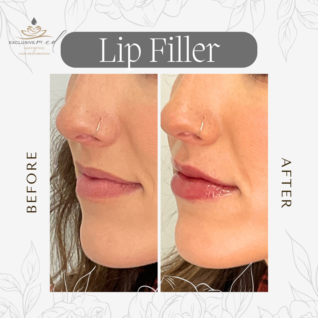 Photo and Informational Flyer Gallery | Exclusive Med Aesthetics ...