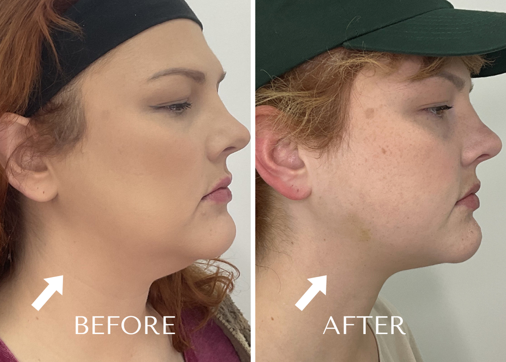 Liquid Lipo, PCDC - Minimally Invasive Fat-Dissolving Procedure ...