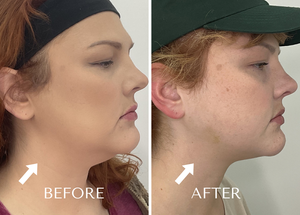 Liquid Lipo, PCDC - Minimally Invasive Fat-Dissolving Procedure ...