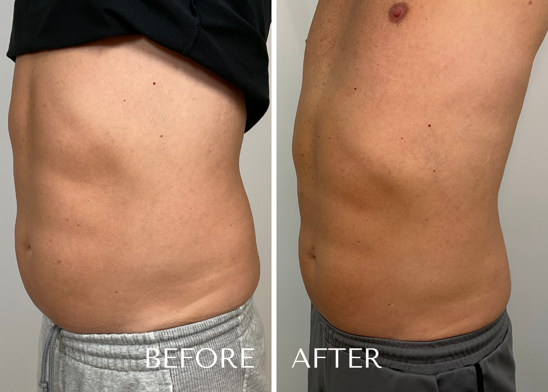 Liquid Lipo, PCDC - Minimally Invasive Fat-Dissolving Procedure ...
