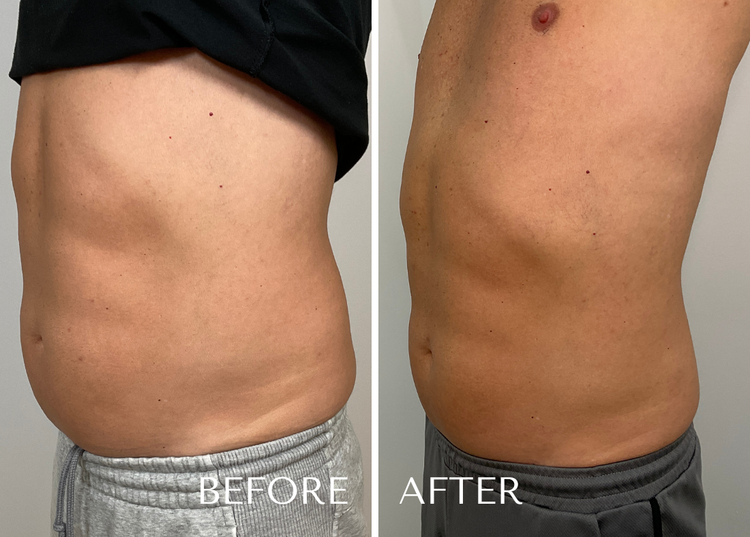 Liquid Lipo, PCDC - Minimally Invasive Fat-Dissolving Procedure ...
