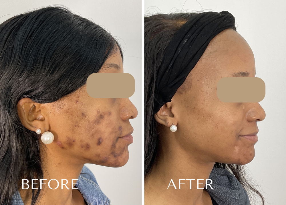 Sciton Contour TRL - NanoLaserPeel, MicroLaserPeel - Aesthetic Laser ...