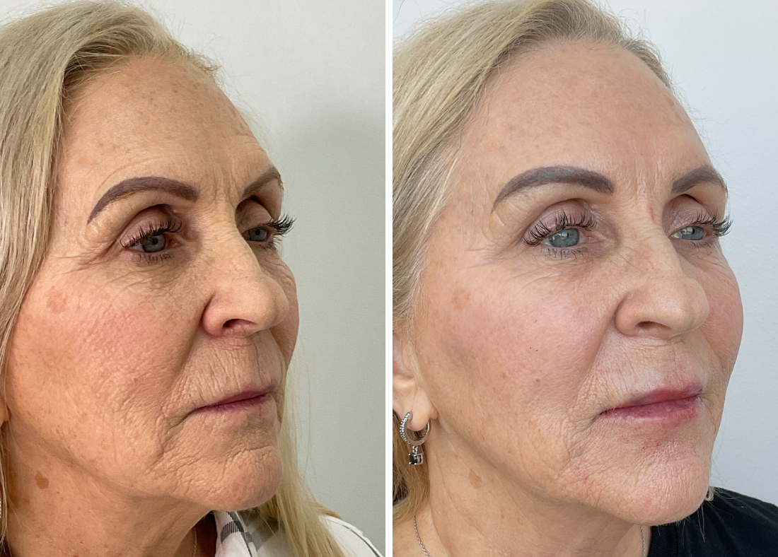 Sciton Contour TRL - NanoLaserPeel, MicroLaserPeel - Aesthetic Laser ...