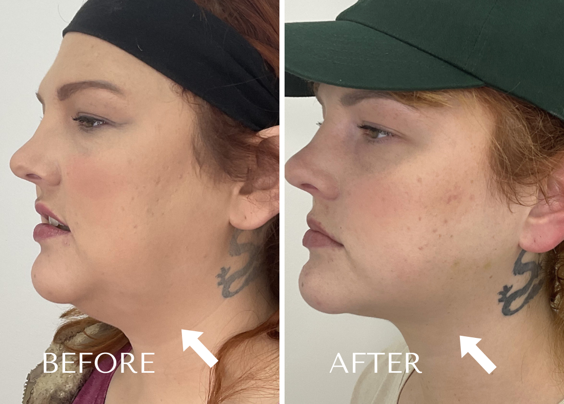 Liquid Lipo, PCDC - Minimally Invasive Fat-Dissolving Procedure ...