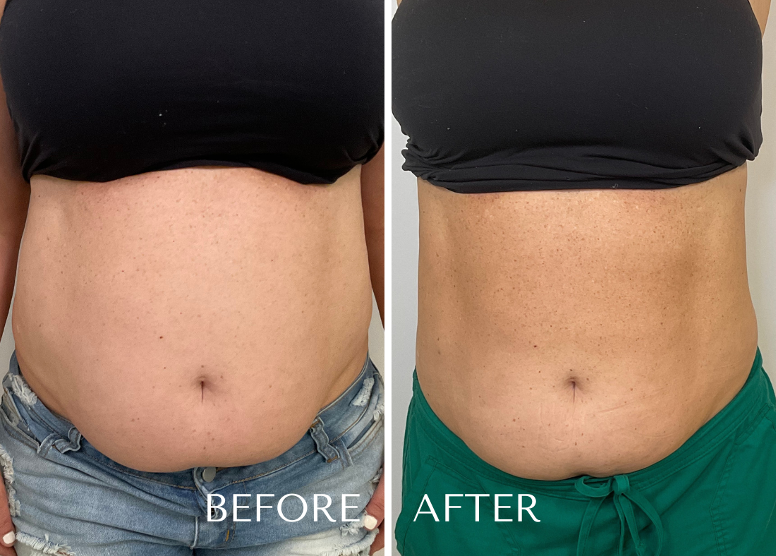 Liquid Lipo, PCDC - Minimally Invasive Fat-Dissolving Procedure ...