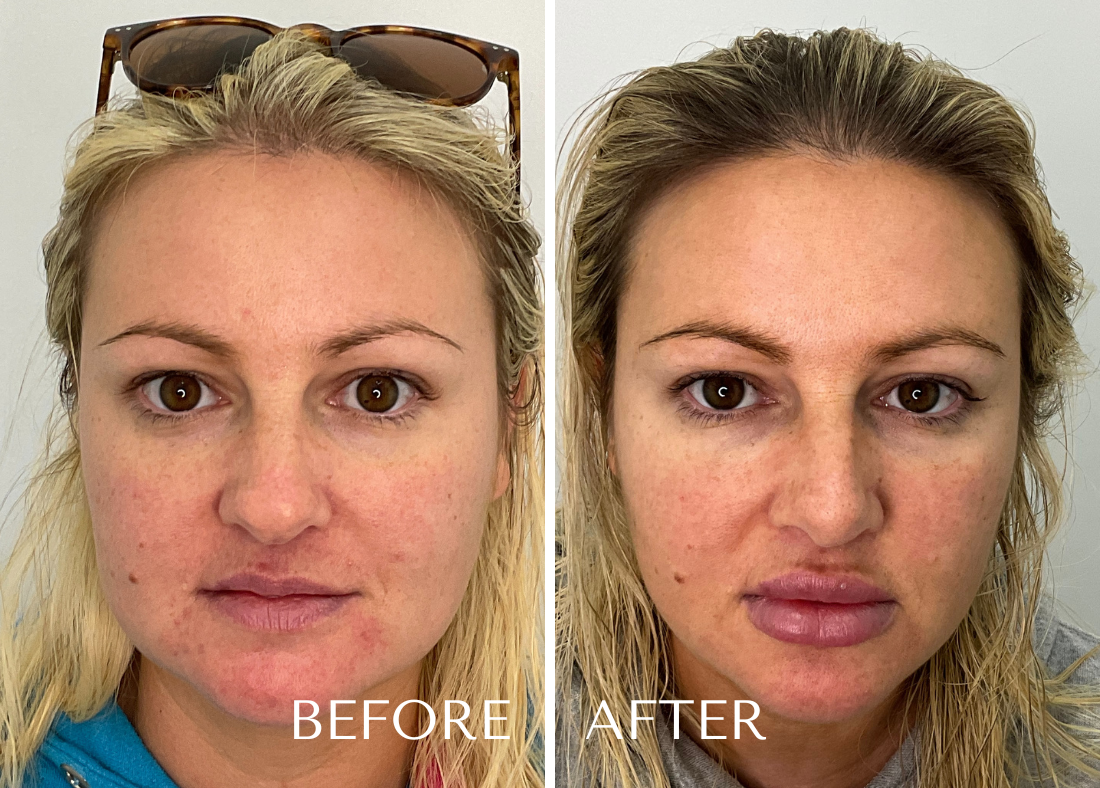 Liquid Lipo, PCDC - Minimally Invasive Fat-Dissolving Procedure ...