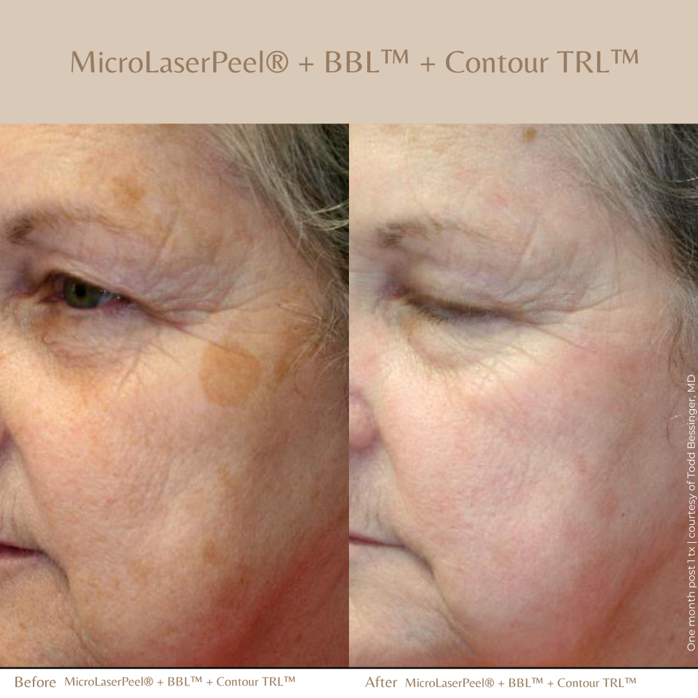 Sciton Contour TRL - NanoLaserPeel, MicroLaserPeel - Aesthetic Laser ...