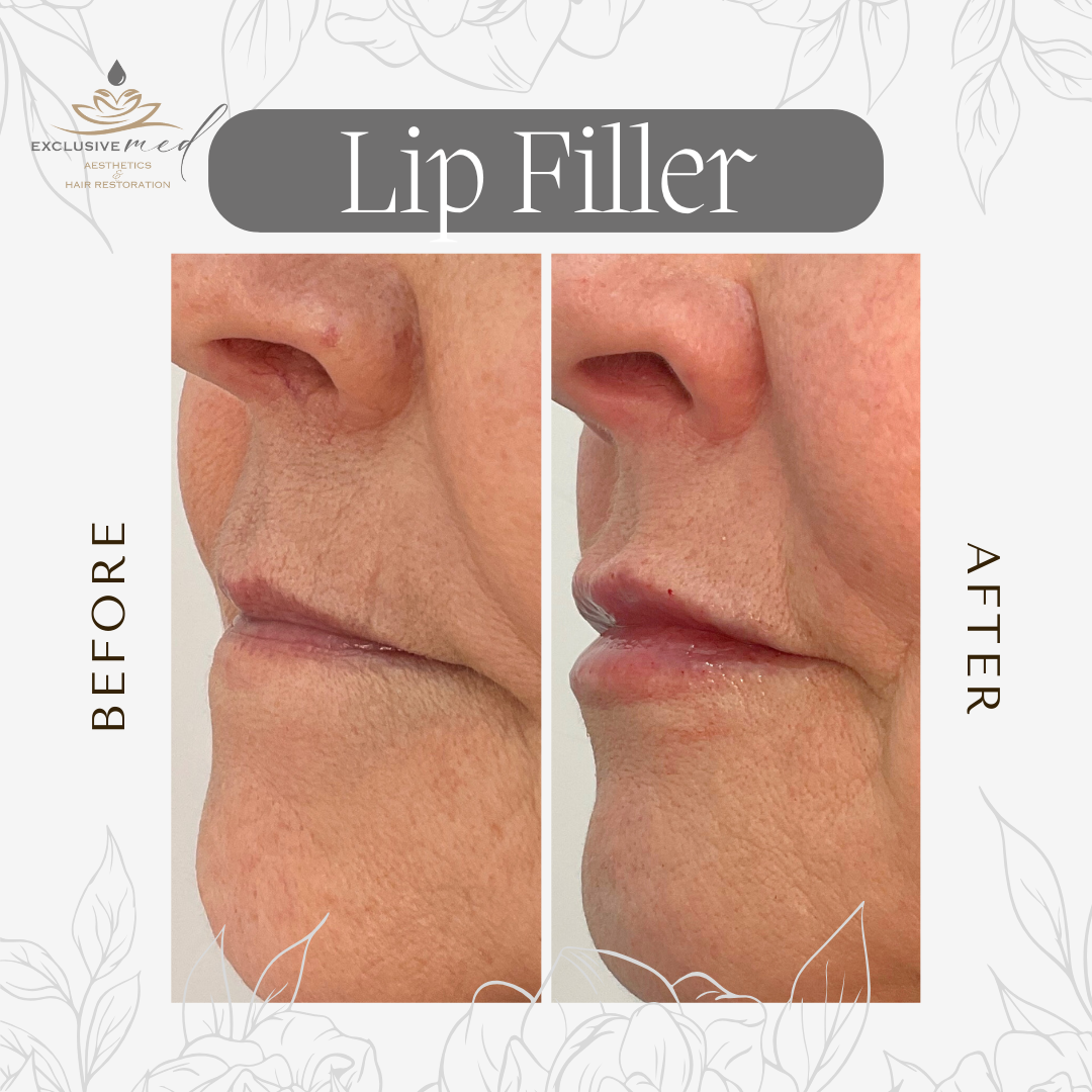 Photo and Informational Flyer Gallery | Exclusive Med Aesthetics ...