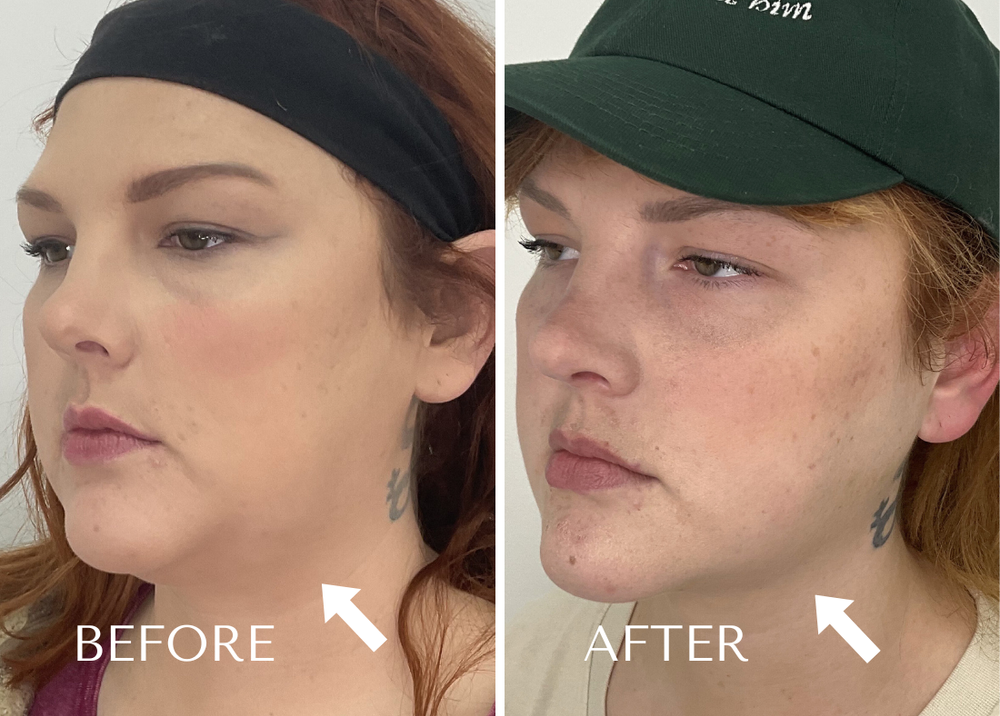 Liquid Lipo, PCDC - Minimally Invasive Fat-Dissolving Procedure ...