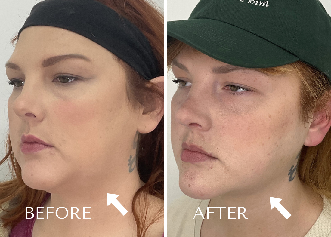 Liquid Lipo, PCDC - Minimally Invasive Fat-Dissolving Procedure ...