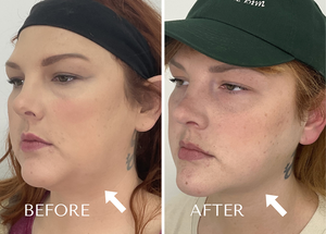 Liquid Lipo, PCDC - Minimally Invasive Fat-Dissolving Procedure ...