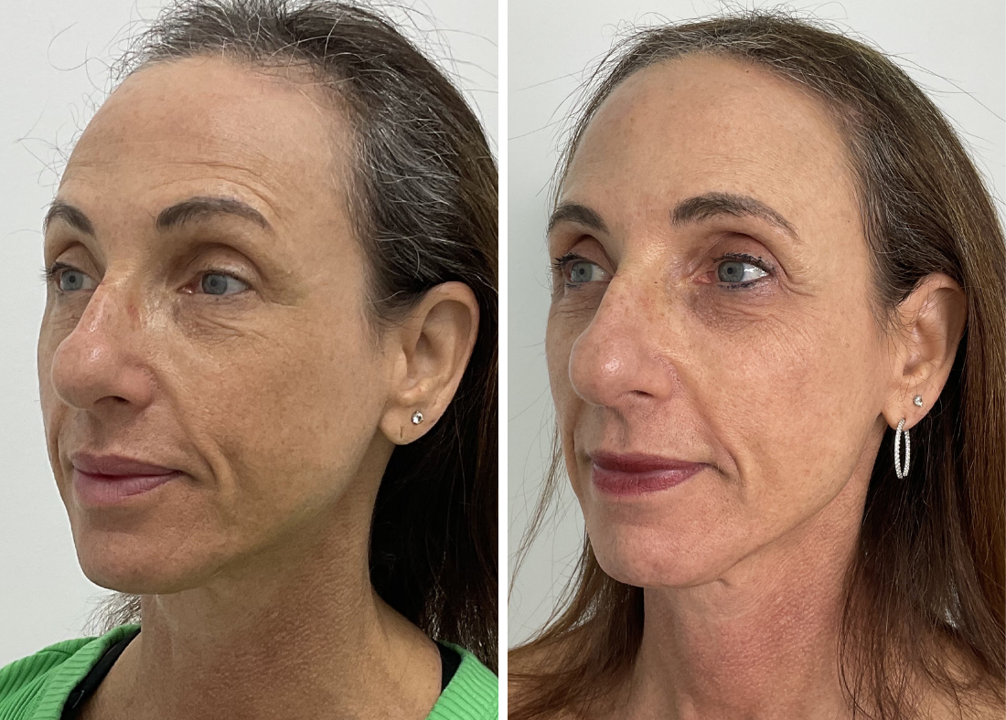 Sciton Contour TRL - NanoLaserPeel, MicroLaserPeel - Aesthetic Laser ...