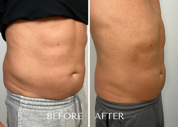 Liquid Lipo, PCDC - Minimally Invasive Fat-Dissolving Procedure ...