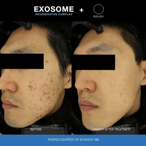 Benev Exosomes - Enhance Your Treatment With Topical Growth Factors ...