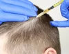 Hair Restoration - Dutasteride Mesotherapy Injections — Exclusive Med ...