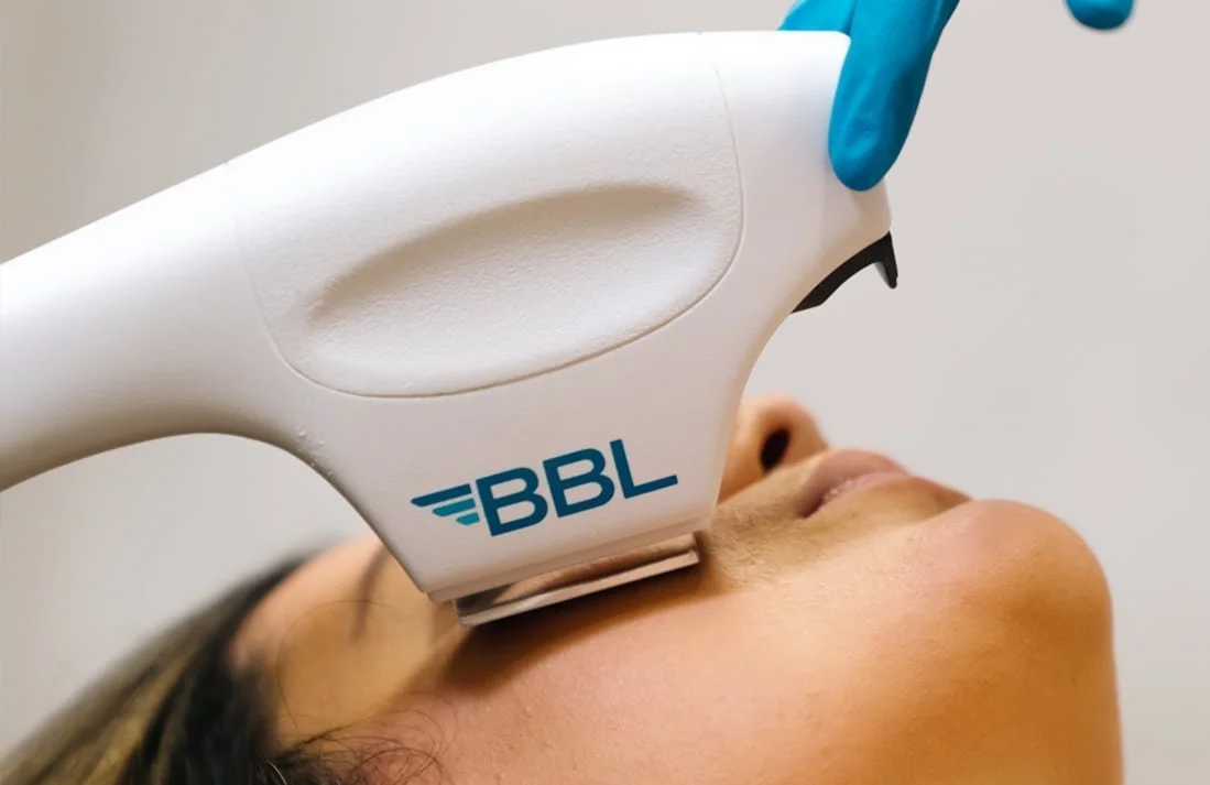 Sciton BBL Laser Treatments - Broad Band Light - BBL Forever Young, BBL Hero - Aesthetic Laser ...