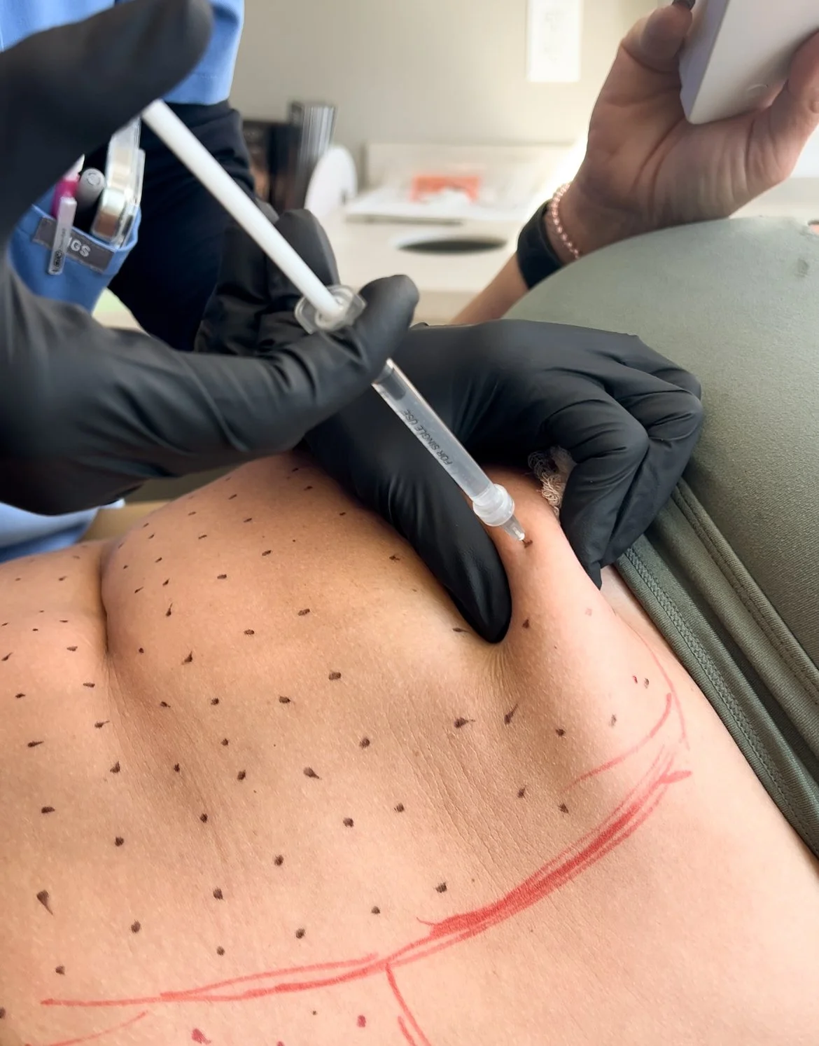 Liquid Lipo, PCDC - Minimally Invasive Fat-Dissolving Procedure ...