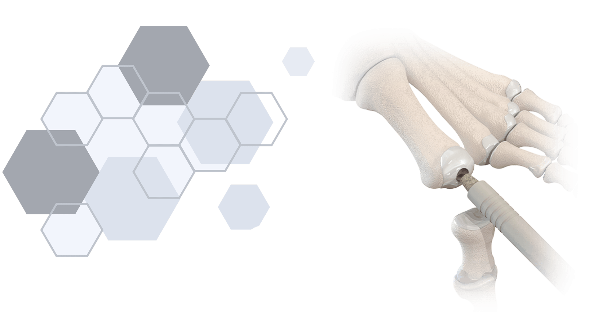 FIXATION: ConMed | In2Bones | Discover Innovative Fixation Solutions ...