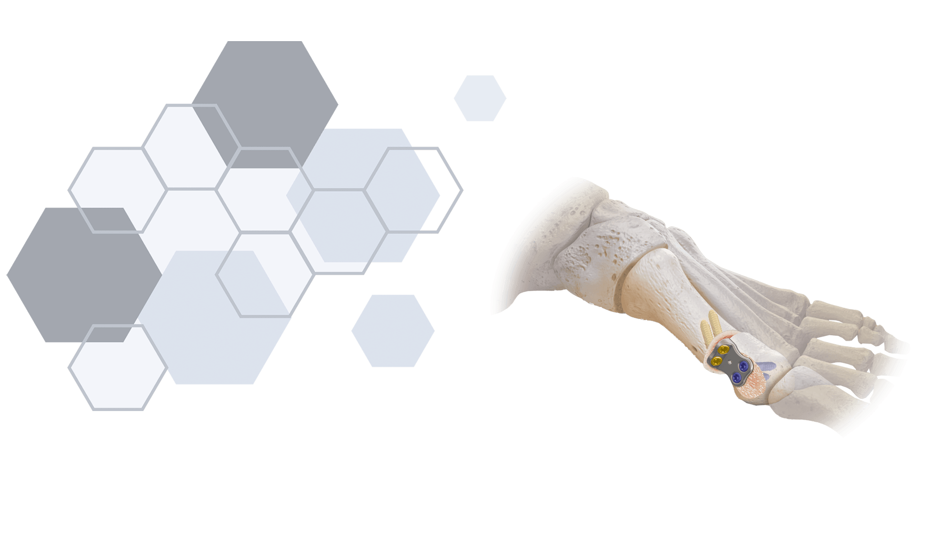 FIXATION: ConMed | In2Bones | Discover Innovative Fixation Solutions ...