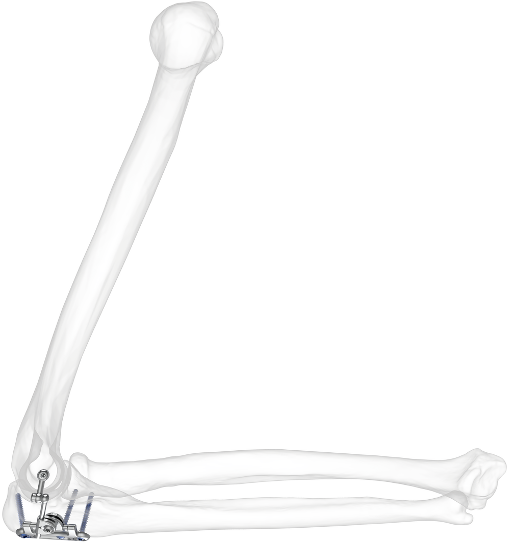 FIXATION: Skeletal Dynamics | Explore Advanced Fixation Solutions ...