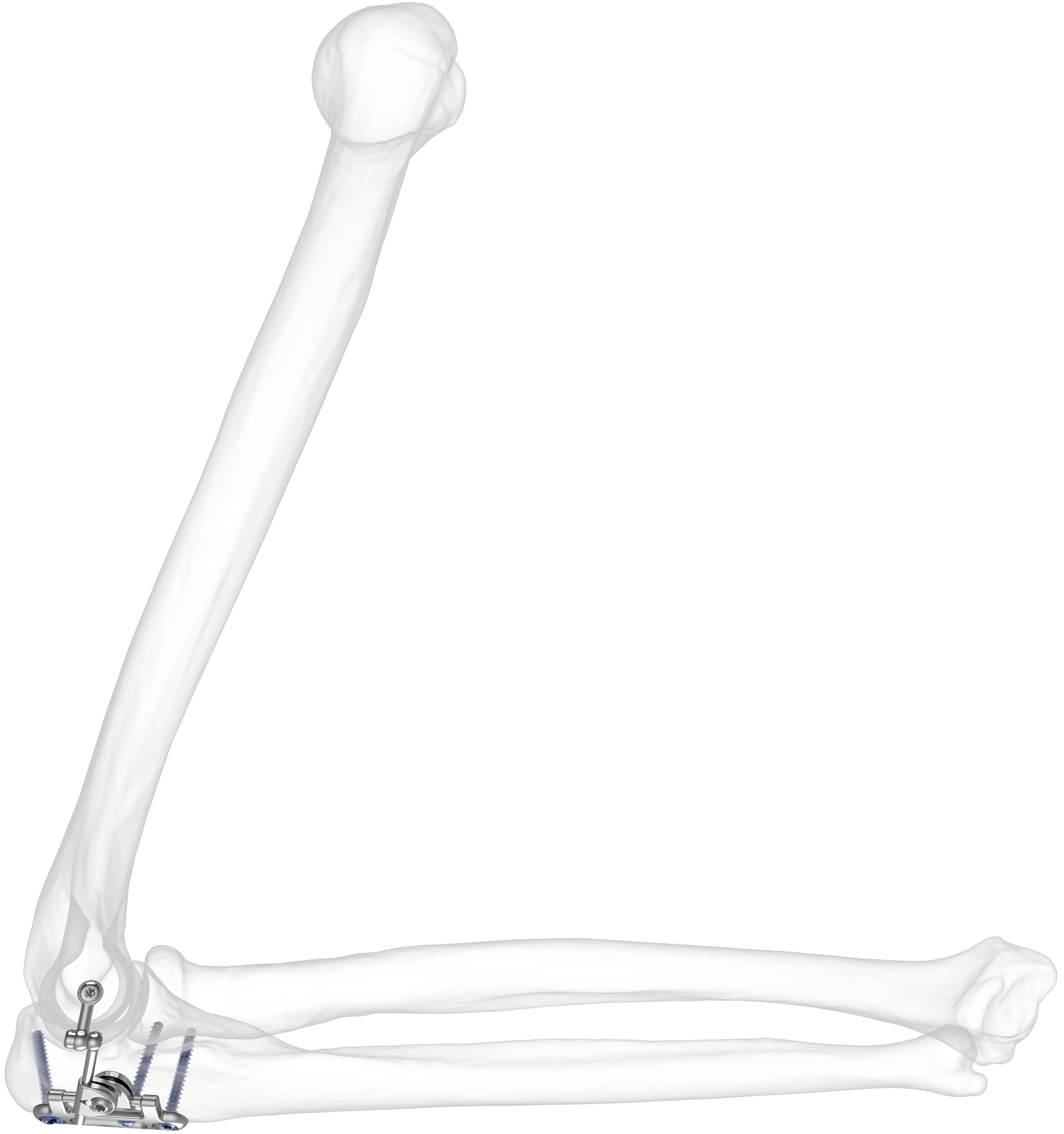 FIXATION: Skeletal Dynamics | Explore Advanced Fixation Solutions ...