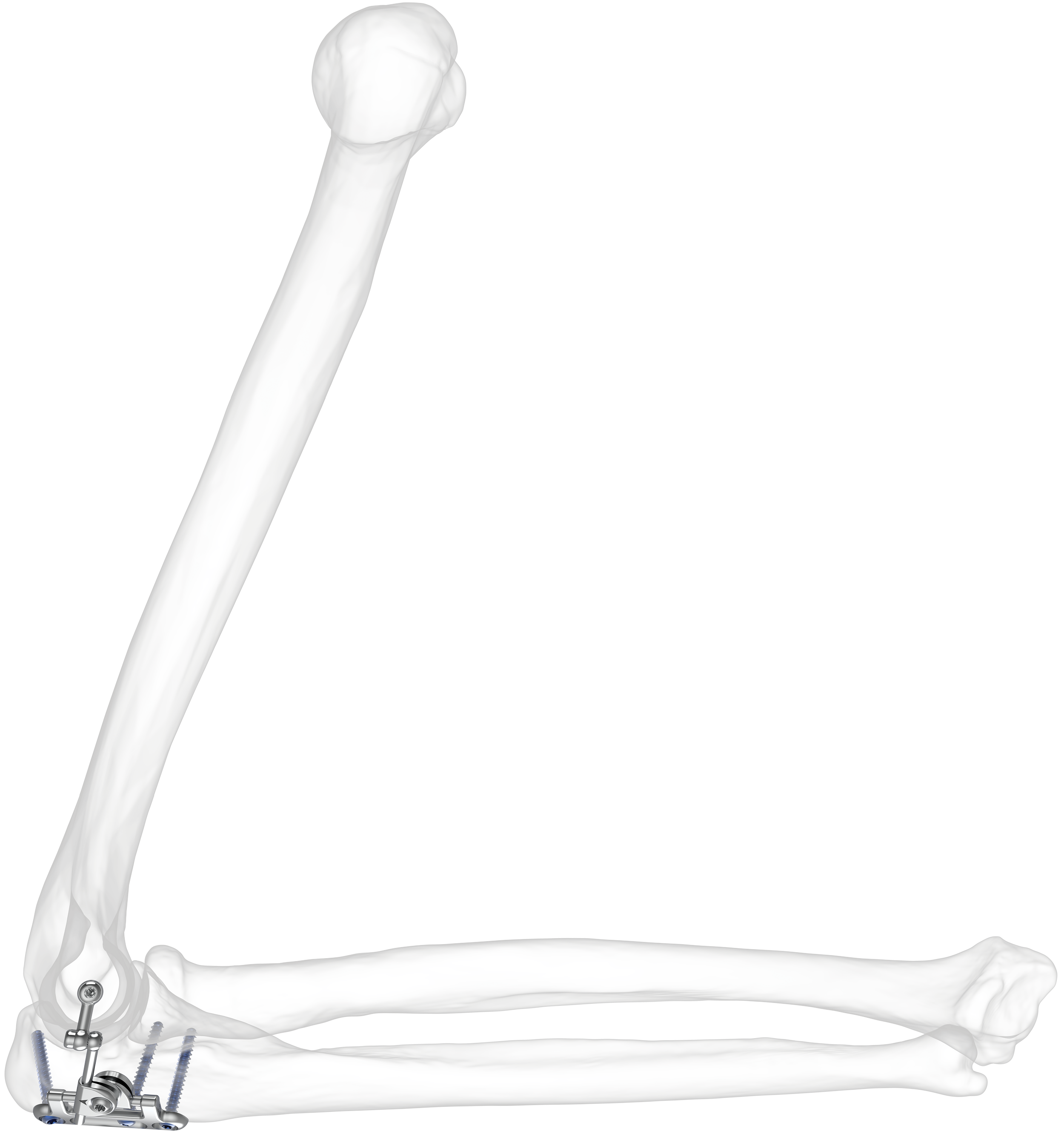 FIXATION: Skeletal Dynamics | Explore Advanced Fixation Solutions ...