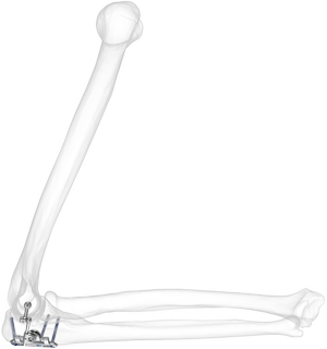 FIXATION: Skeletal Dynamics | Explore Advanced Fixation Solutions ...