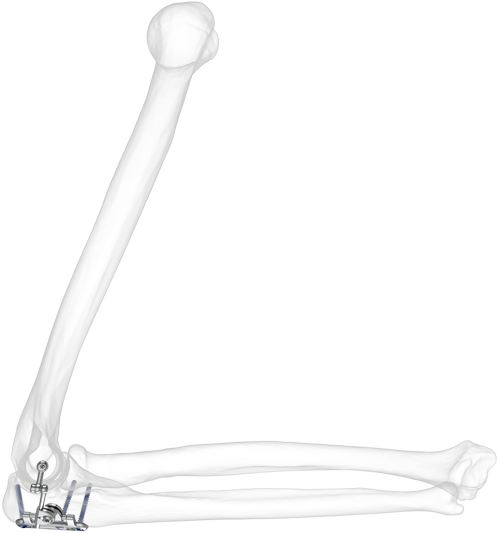 FIXATION: Skeletal Dynamics | Explore Advanced Fixation Solutions ...