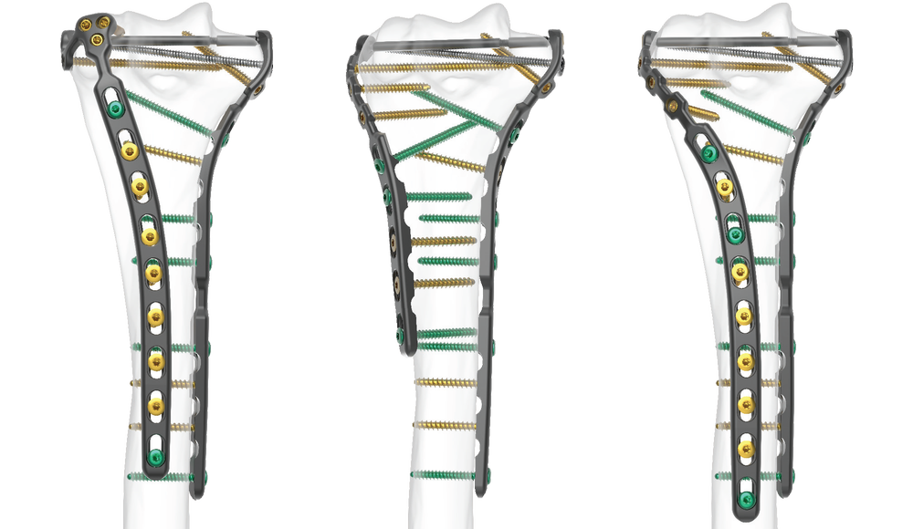 FIXATION: Skeletal Dynamics | Explore Advanced Fixation Solutions ...