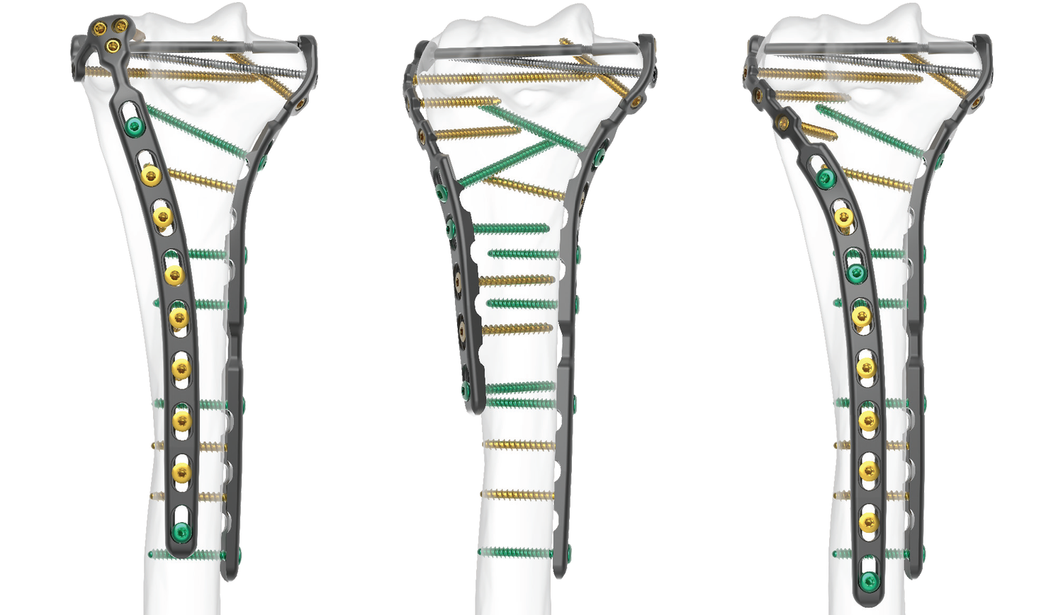 FIXATION: Skeletal Dynamics | Explore Advanced Fixation Solutions ...