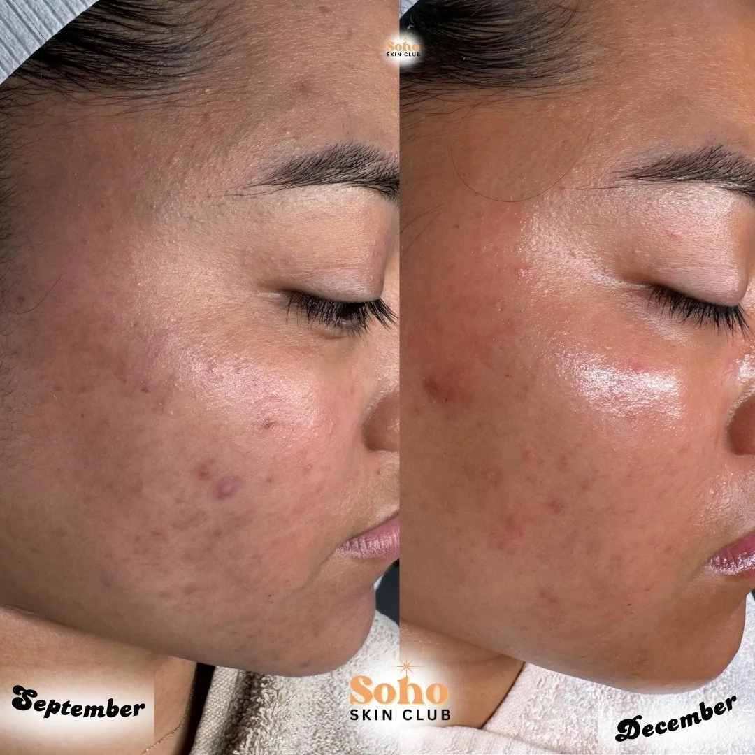 Soho Skin Club – Perth’s Trusted Skin & Facial Clinic in Subiaco