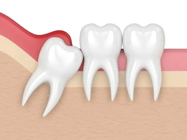 Wisdom Tooth Extraction Dublin | Expert Wisdom Teeth Removal ...