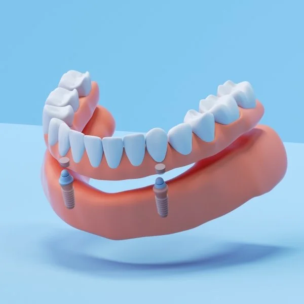 Dental Implants Dublin | Expert Implant Dentistry Services in Ireland ...