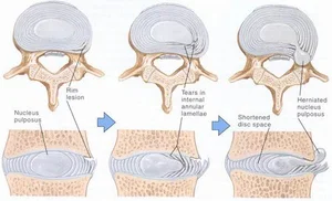A comprehensive guide to understanding spinal disc injuries and how to ...