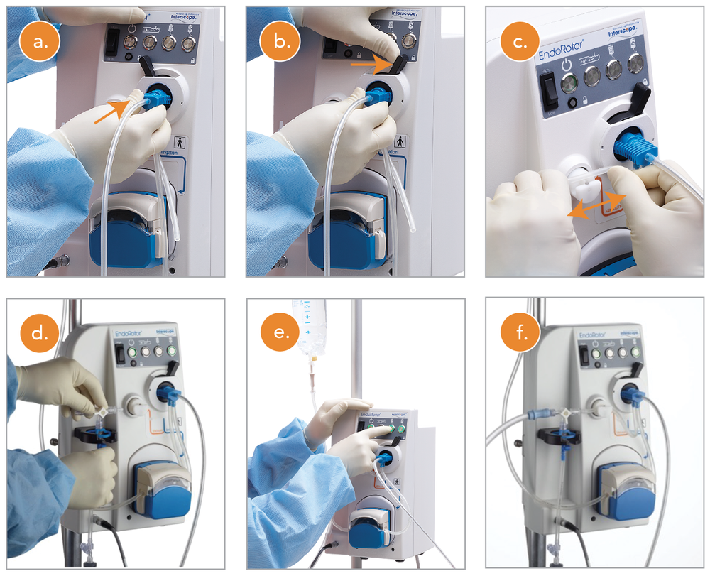 EndoRotor® Procedure — Interscope Endorotor Catheter