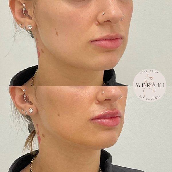 Lip Filler Balancing Before And After — Meraki Aesthetics & Co