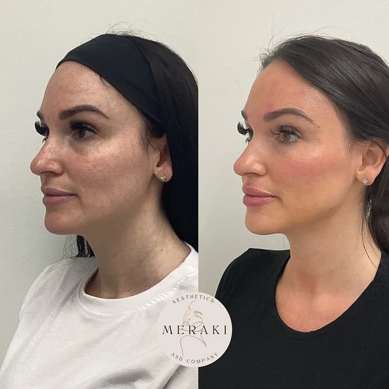 Lip Filler Balancing Before And After — Meraki Aesthetics & Co