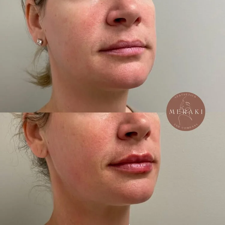 Lip Filler Balancing Before And After — Meraki Aesthetics & Co
