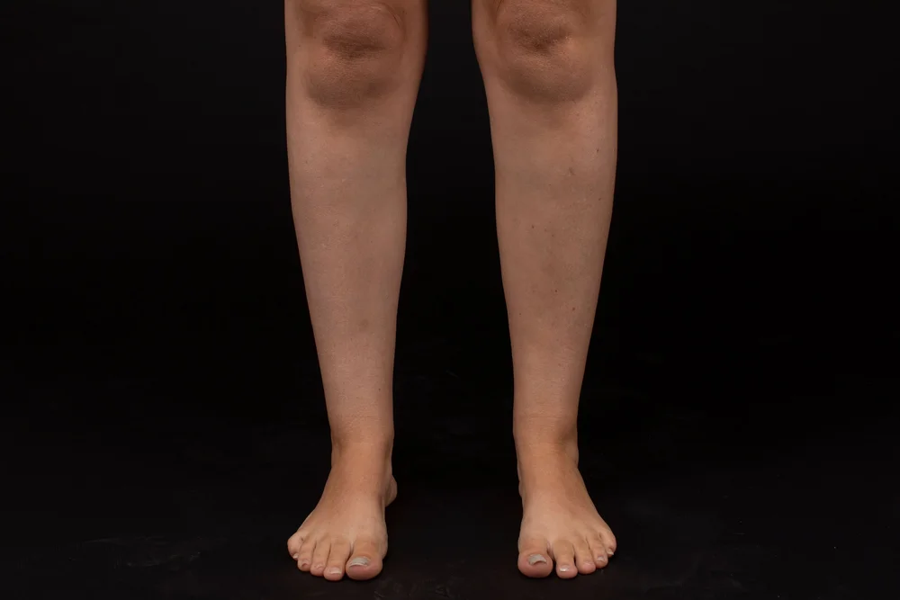 What Does Lipoedema Look Like? — Lipoedema Australia