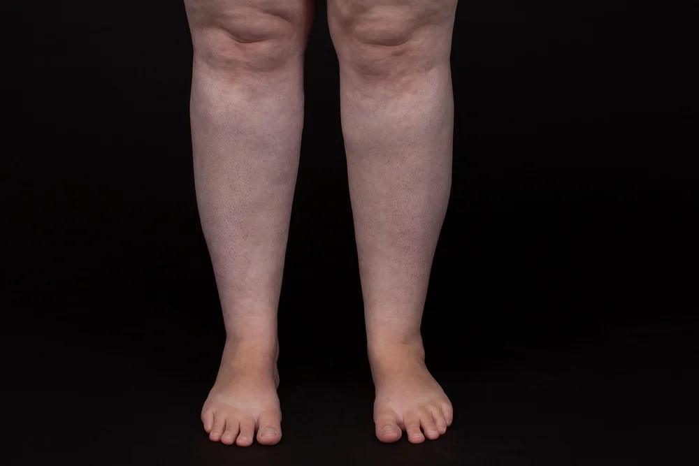 What Does Lipoedema Look Like? — Lipoedema Australia