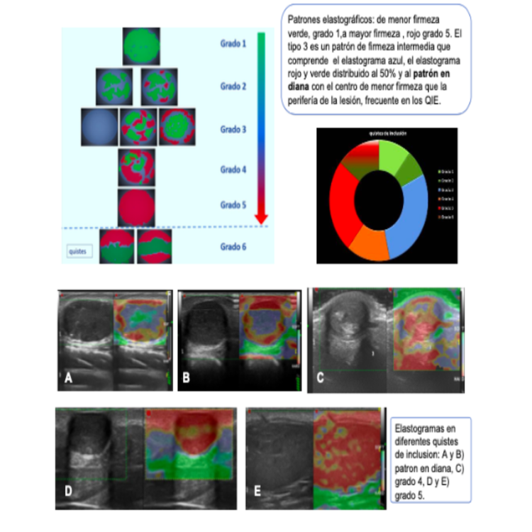 Quiste de Inclusión Epidérmico y sus Características Ecográficas ...