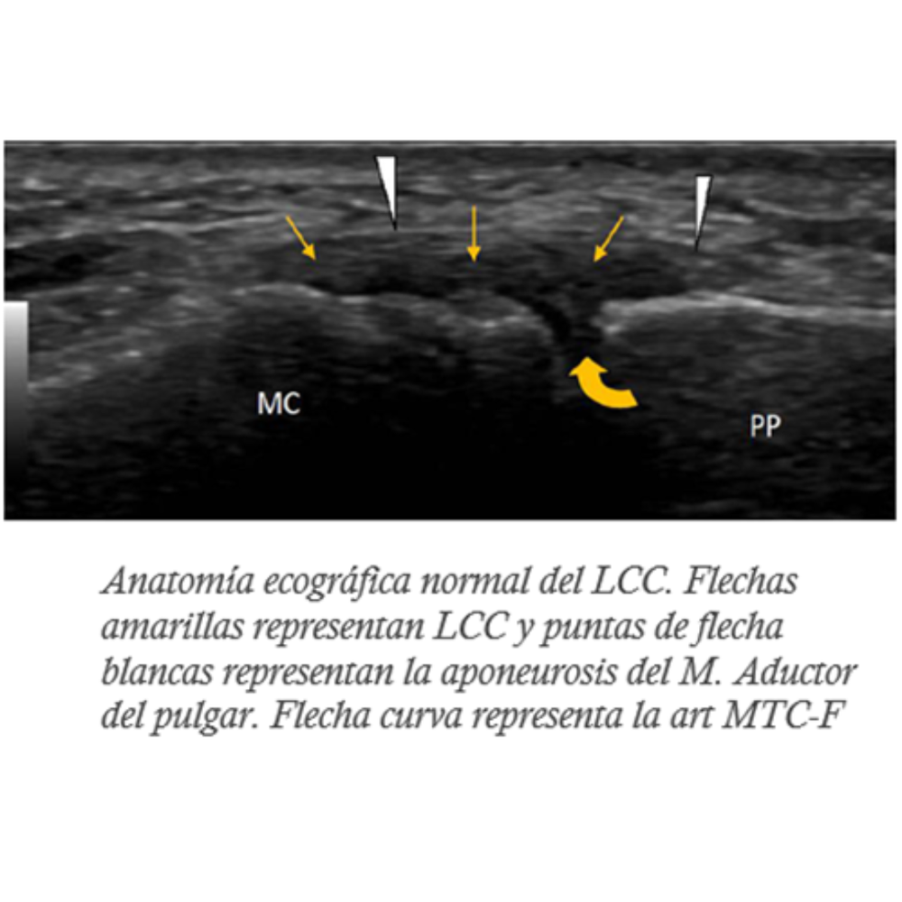 Lesiones del Ligamento Colateral Cubital del Pulgar: Más que lesión de ...