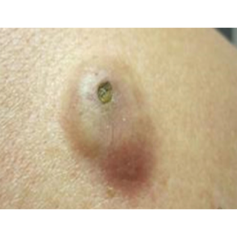 Quiste de Inclusión Epidérmico y sus Características Ecográficas ...