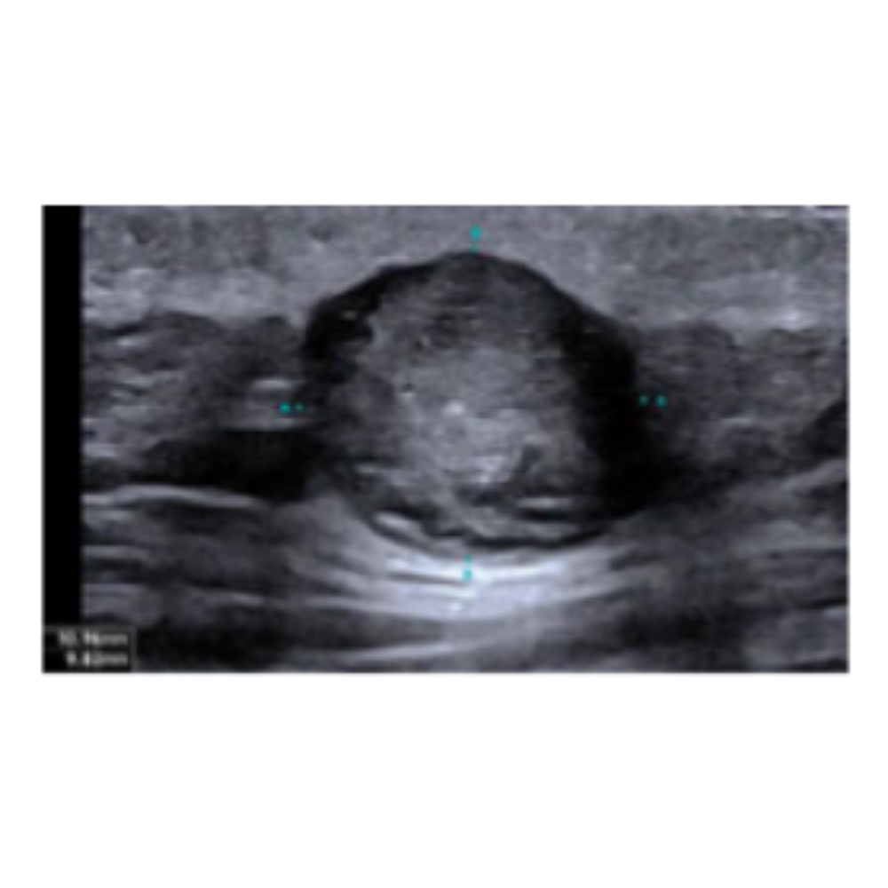 Quiste de Inclusión Epidérmico y sus Características Ecográficas ...