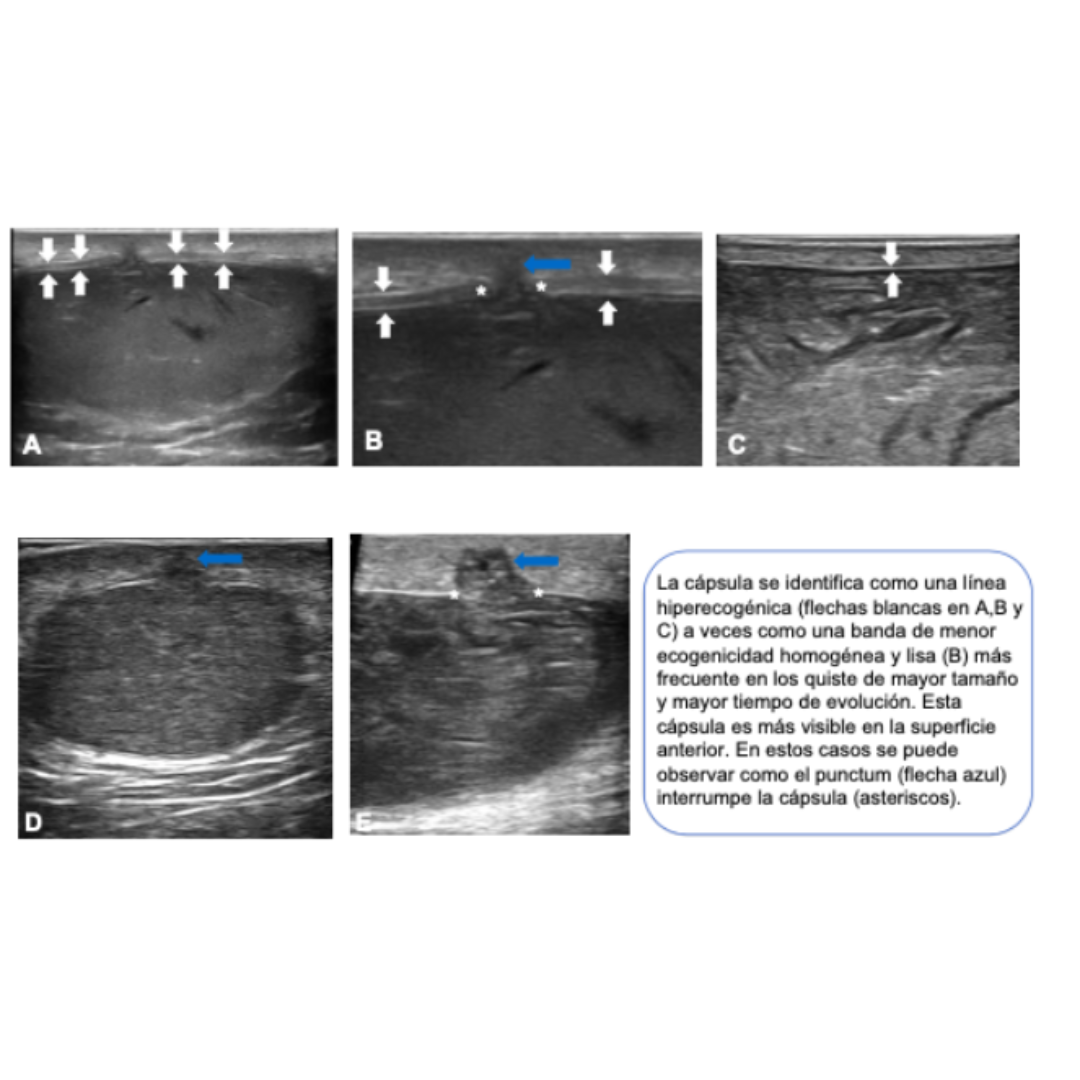 Quiste de Inclusión Epidérmico y sus Características Ecográficas ...