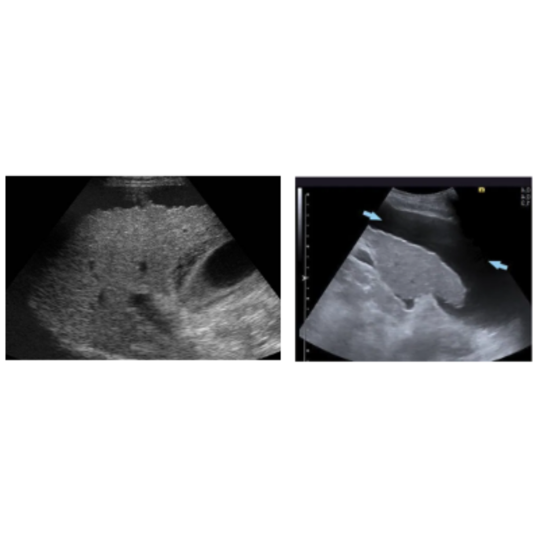 Daño Hepático Crónico: Hallazgos Ecográficos Importantes en Hepatopatía ...